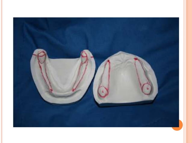 Lingualised occlusion revisited | PPTX