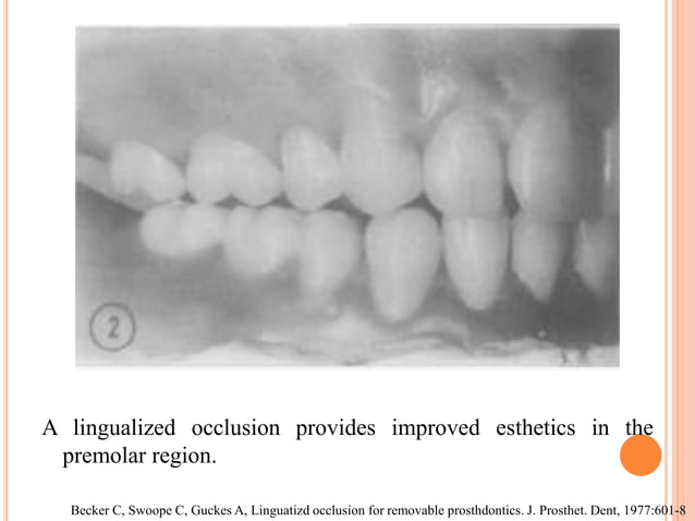 Lingualised occlusion revisited | PPTX