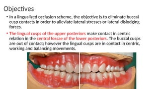 lingualized occlusion in complete dentures.pptx