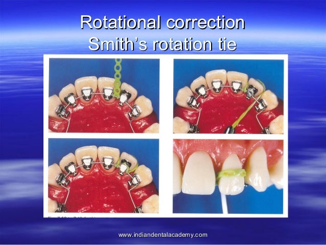 Lingual orthodontics /certified fixed orthodontic courses by Indian