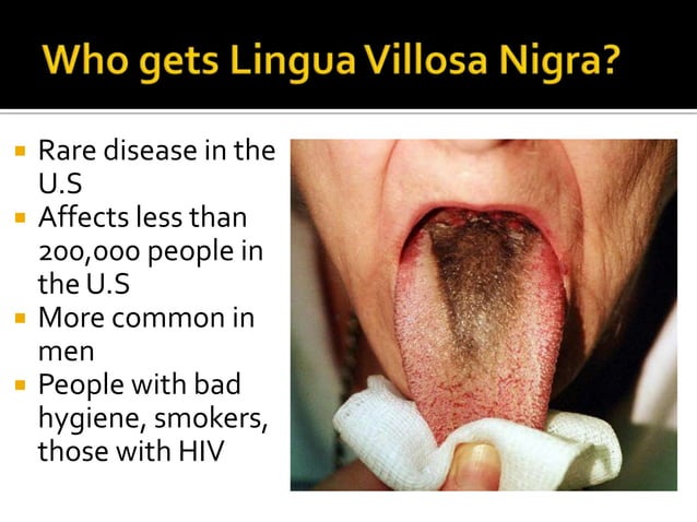 Lingua villosa nigra