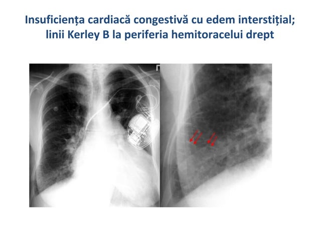 Linii kerley | PPT