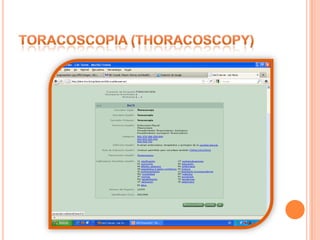 Toracoscopia | PPTX