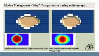 Significance of Robust Motion Management & Approaches In Radiotherapy ...
