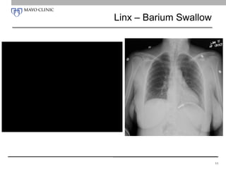 Advances in Managing GERD - LINX | PPT