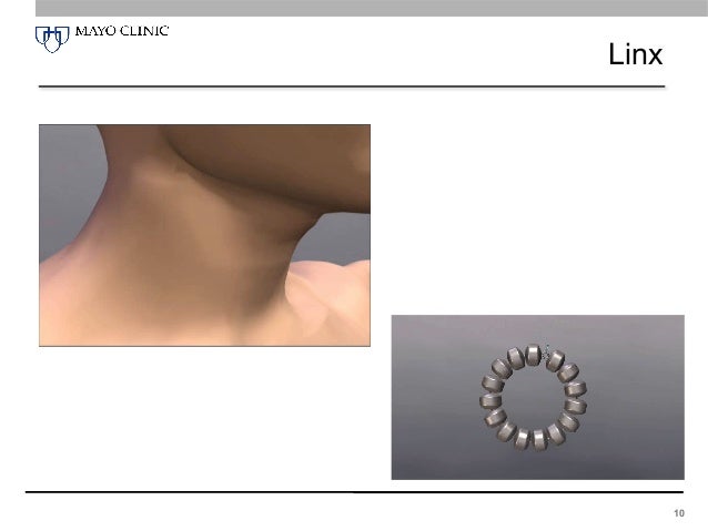 Advances in Managing GERD - LINX