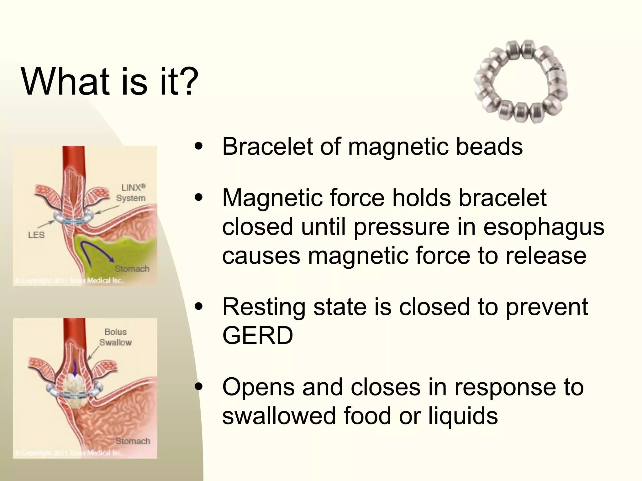 New Offering for GERD | KEY