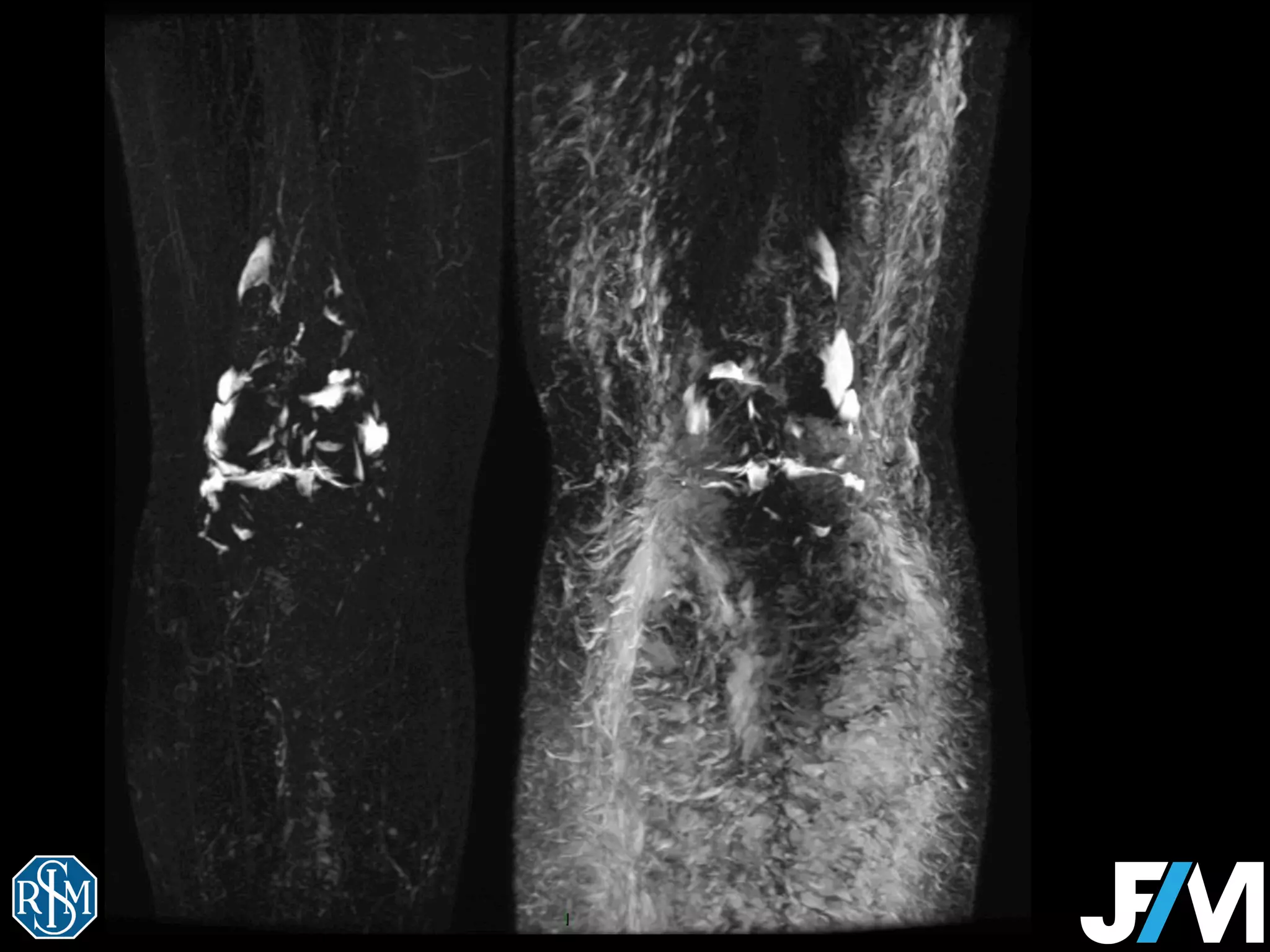 Lionel Arrive, non contrast mr lymphography, jfim ifupi milan 2018 ...