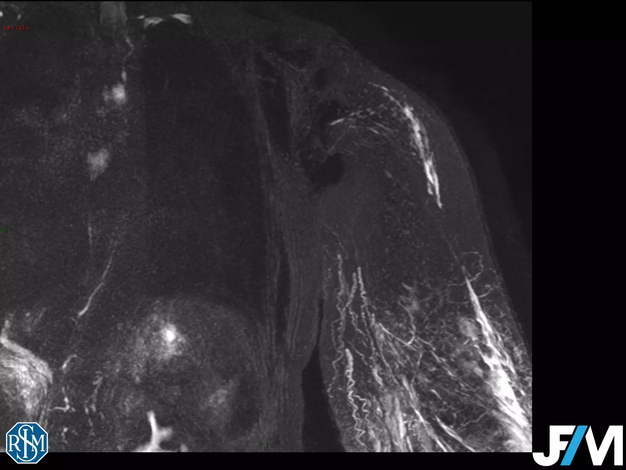 Lionel Arrive, non contrast mr lymphography, jfim ifupi milan 2018 ...