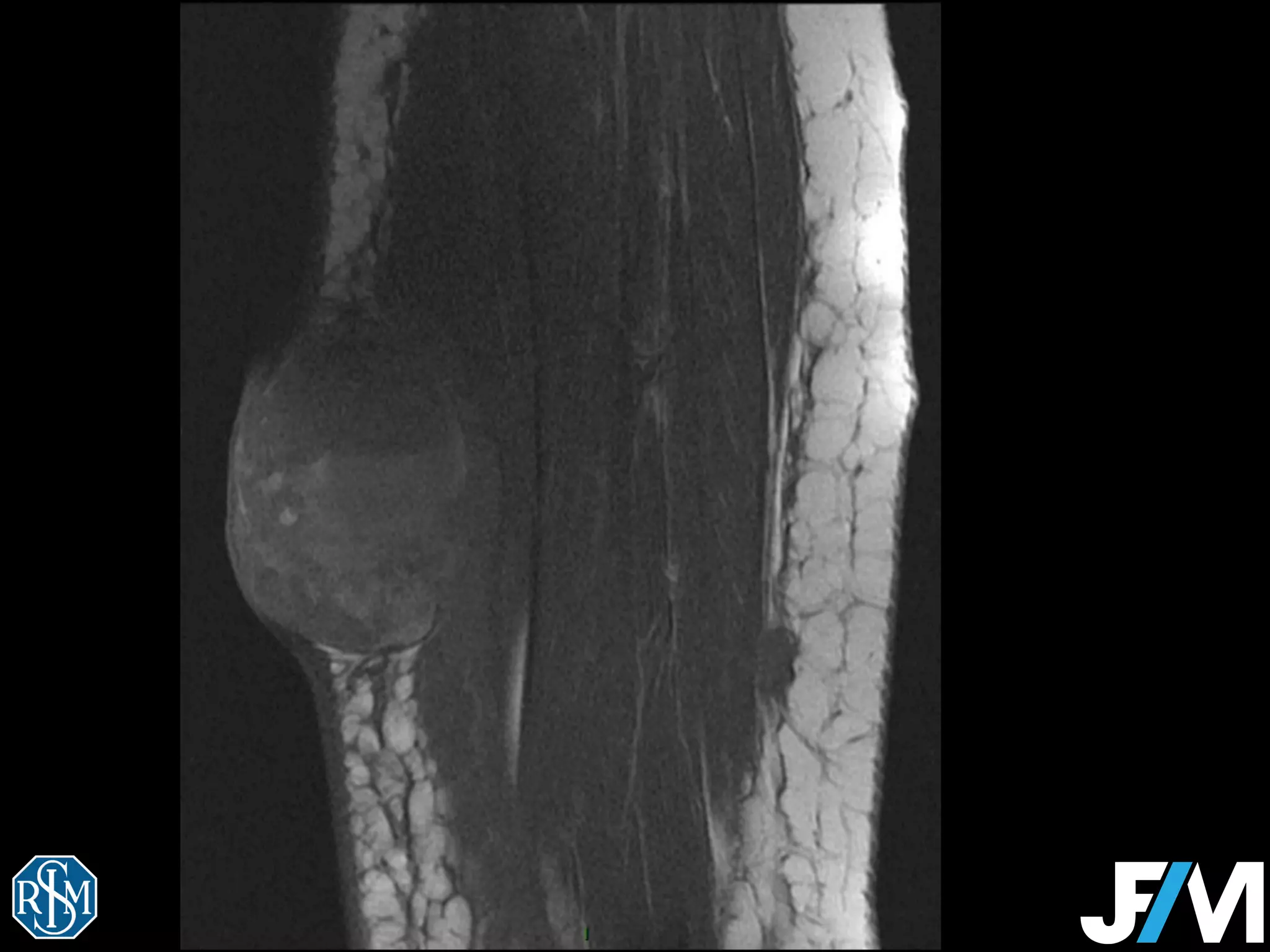 Lionel Arrive, non contrast mr lymphography, jfim ifupi milan 2018 ...