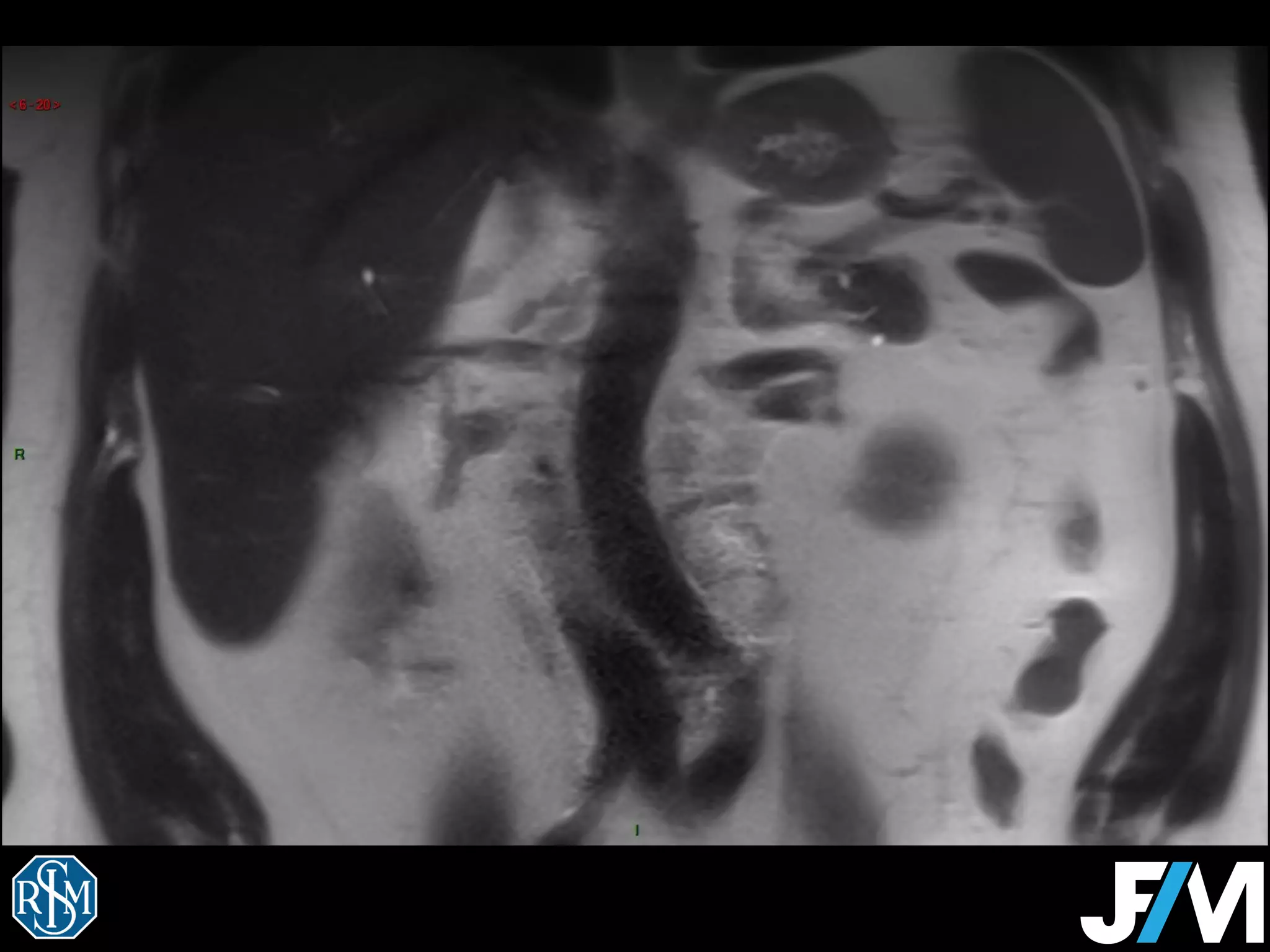 Lionel Arrive, non contrast mr lymphography, jfim ifupi milan 2018 ...