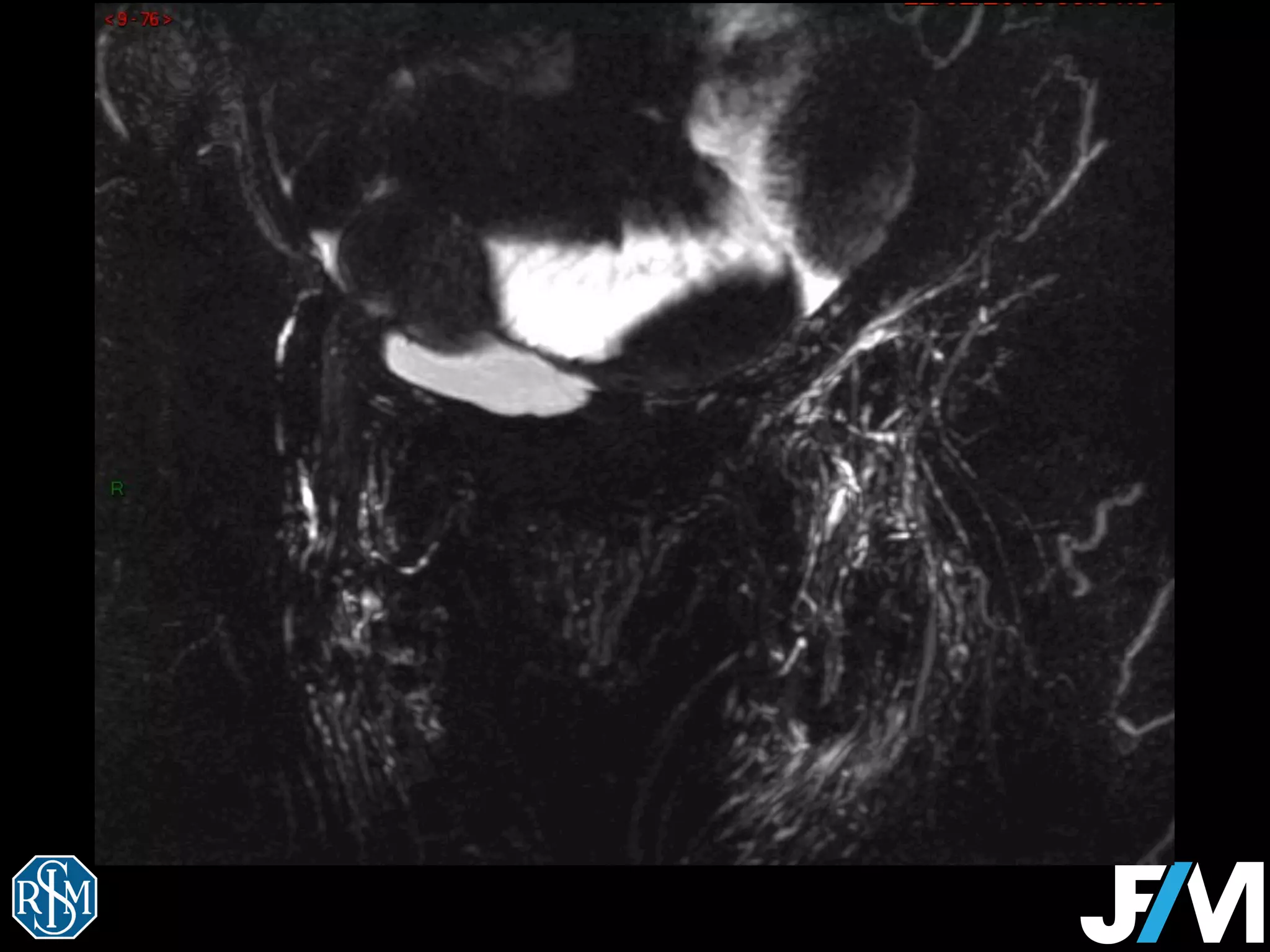 Lionel Arrive, non contrast mr lymphography, jfim ifupi milan 2018 | PPT