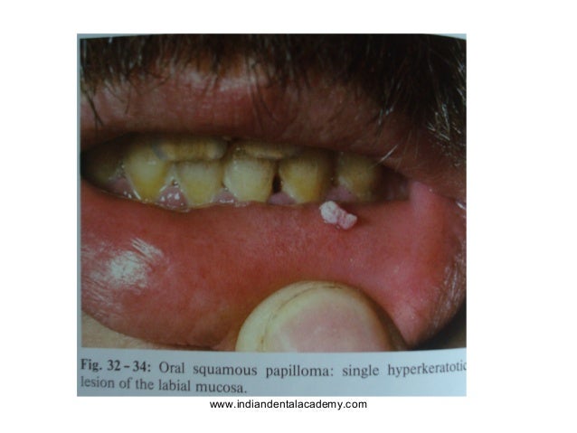 Lesions of Lip/certified fixed orthodontic courses by Indian dental a…