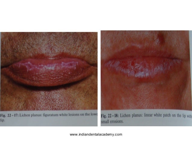 Lesions of Lip/certified fixed orthodontic courses by Indian dental a…