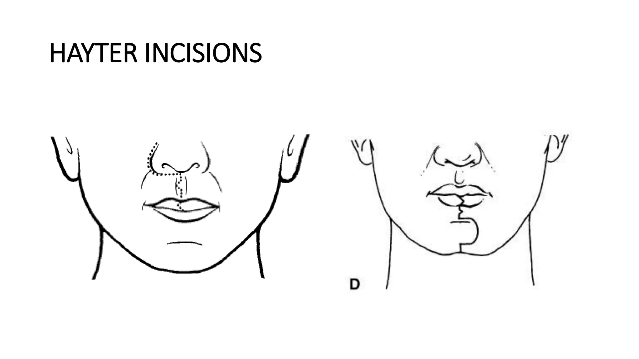 Lip splitting incisions | PPT