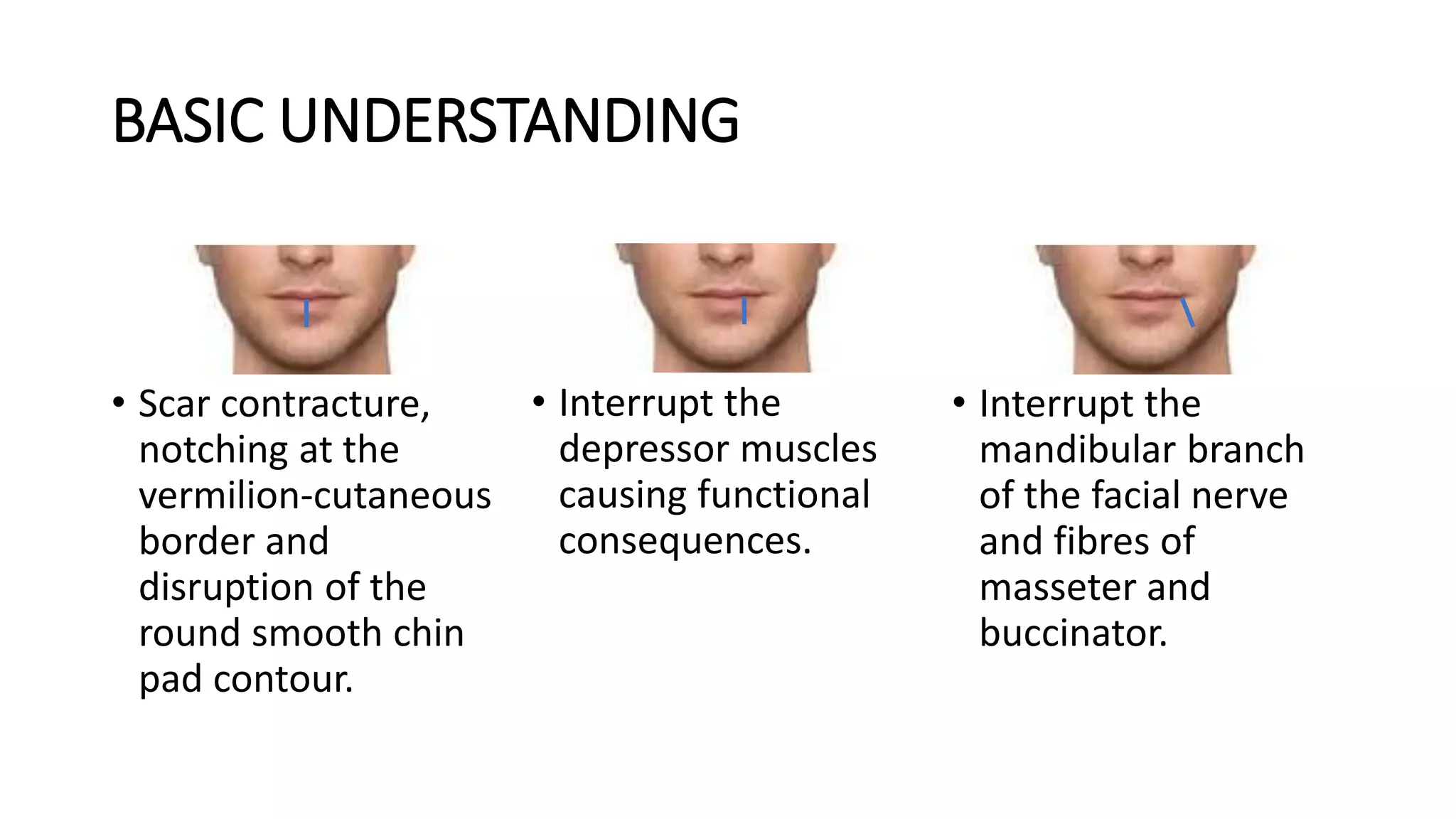 Lip splitting incisions | PPT