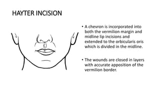Lip splitting incisions | PPT