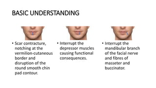 Lip splitting incisions | PPT