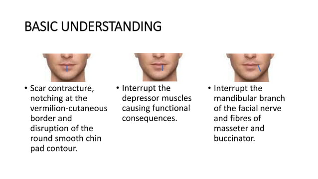 Lip splitting incisions | PPT | Death, Injury, or Military Conflict ...