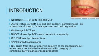 Lip cancer | PPTX | Skin and Dermatology | Diseases and Conditions