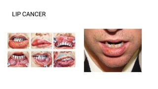 LIP CANCER.pdf