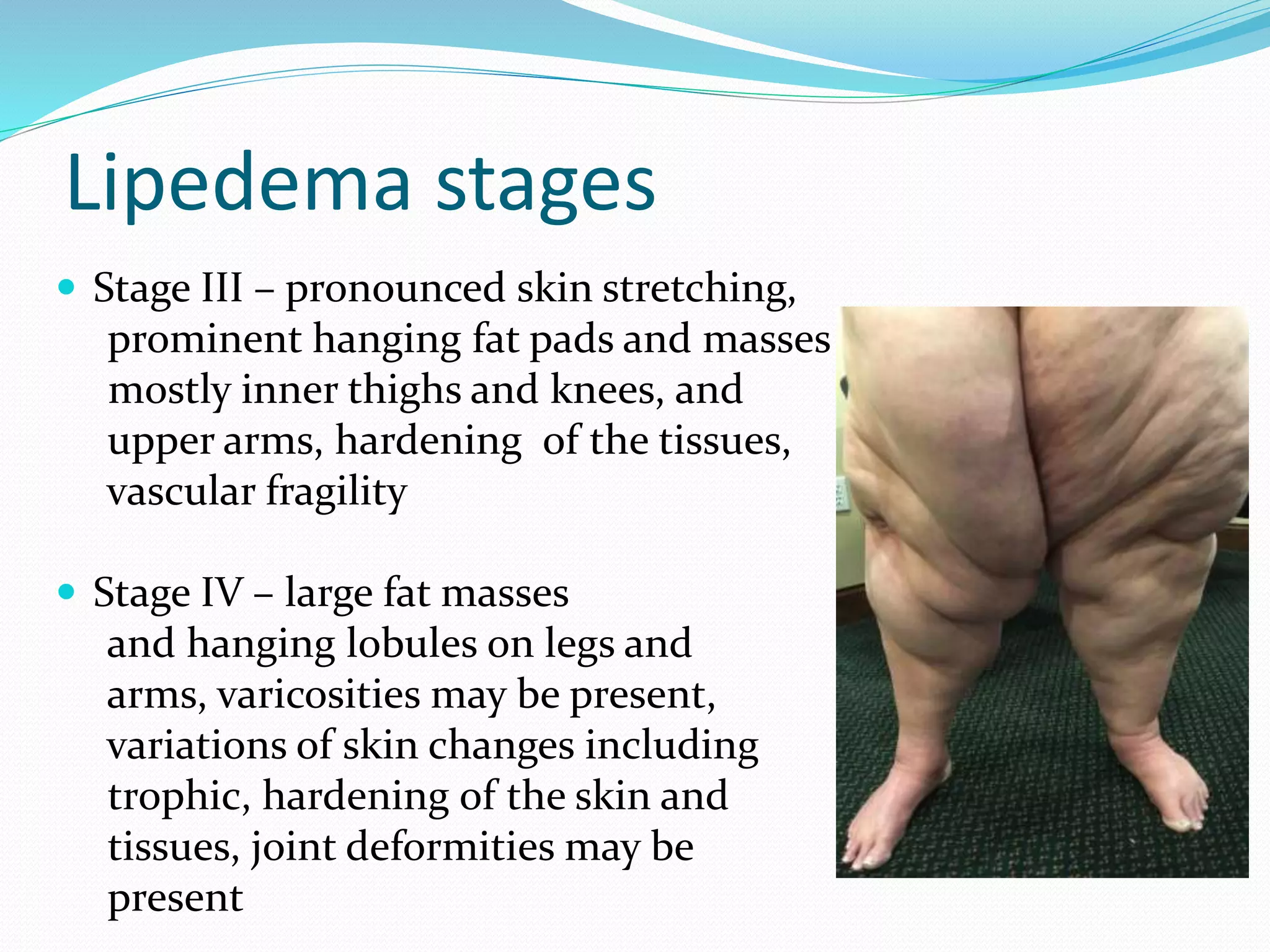 Lipedema: a misdiagnosed and misunderstood fatty deposition syndrome | PPTX