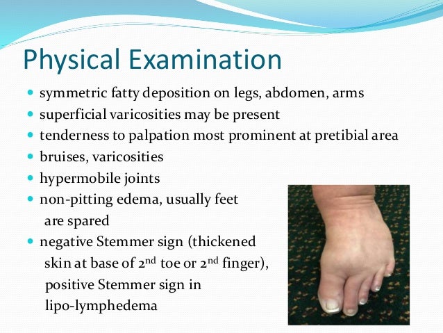Lipedema: a misdiagnosed and misunderstood fatty deposition syndrome