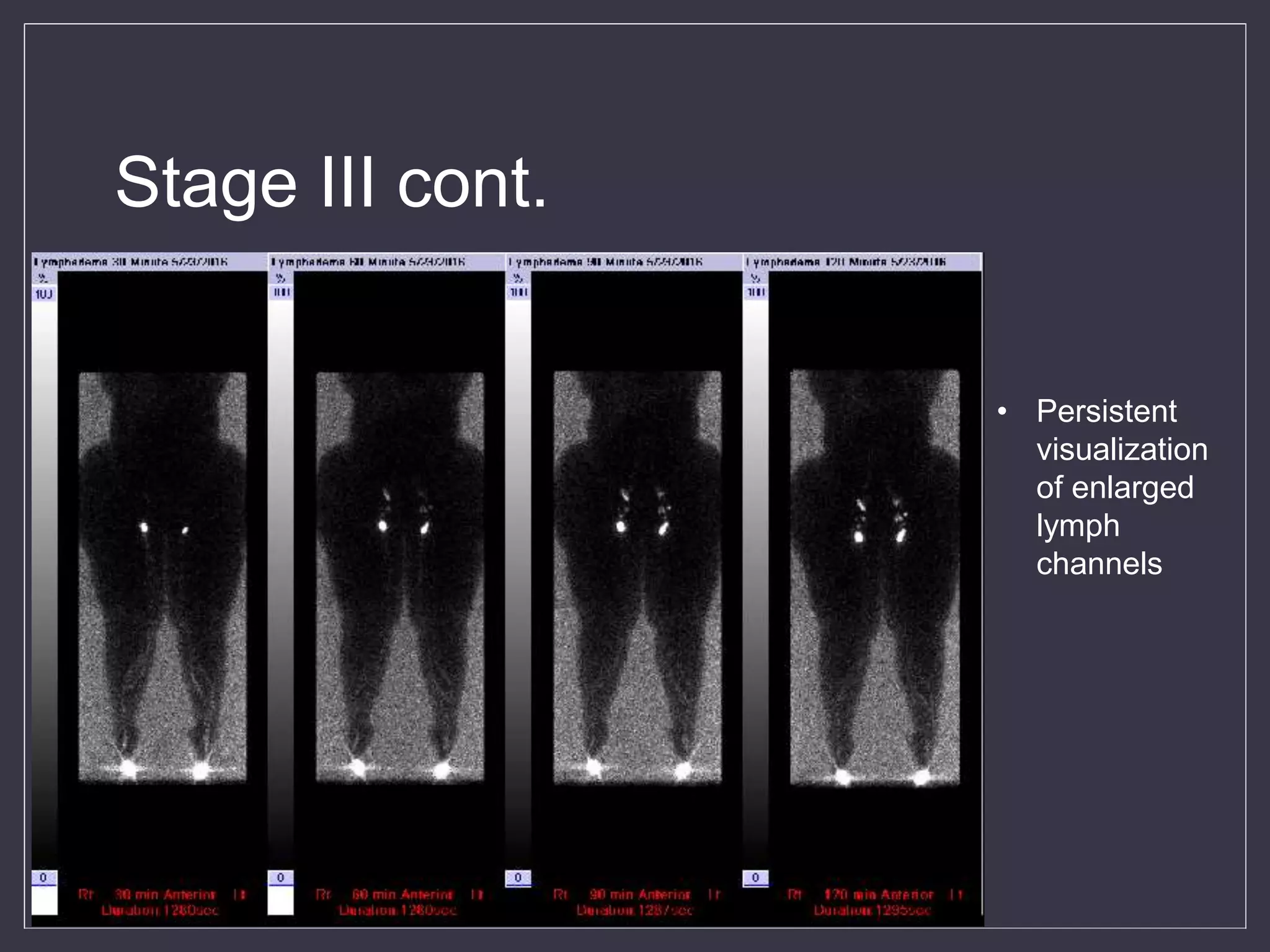 Lipedema: fatty tissue deposition syndrome | PPTX