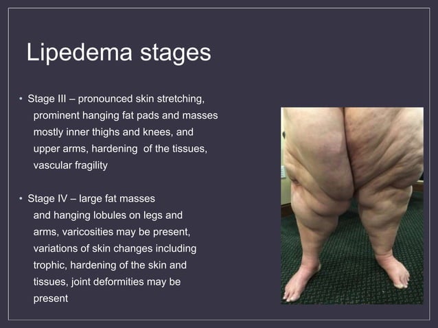 Lipedema: fatty tissue deposition syndrome | PPTX | Endocrine and ...