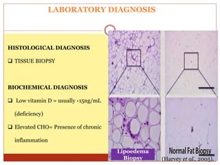 LIPOEDEMA: CLINICAL MANIFESTATTIONS, DIAGNOSIS AND TREATMENT. | PPTX
