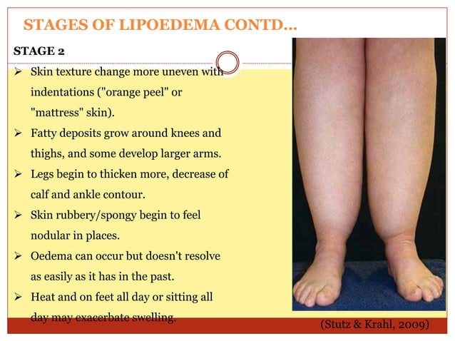 LIPOEDEMA: CLINICAL MANIFESTATTIONS, DIAGNOSIS AND TREATMENT.