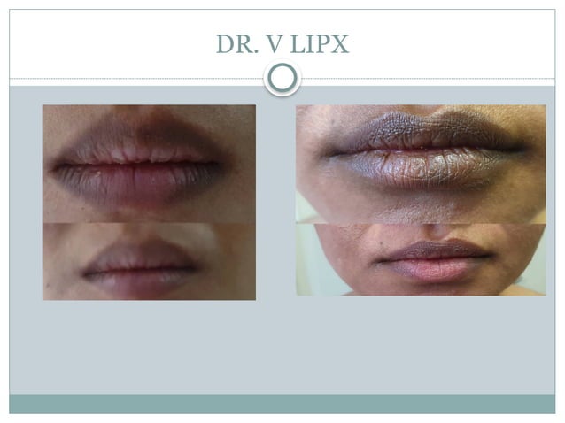 Lip Hyperpigmentation.pptx defines anatomy causes | PPT
