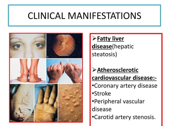 LIPID LOWERING THERAPY.pptx