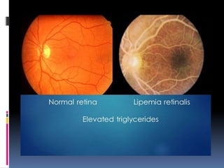 Lipemia Retinalis