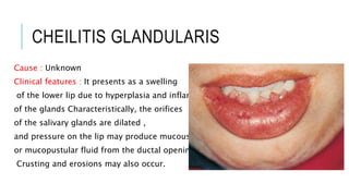 Cheilitis Glandularis