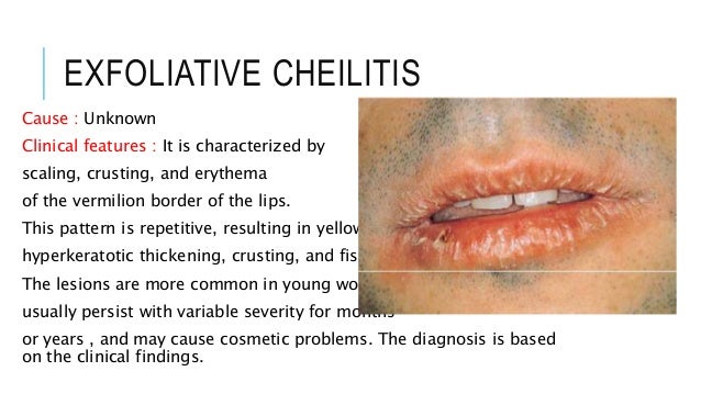 Exfoliative Cheilitis Causes Treatment Prevention And More