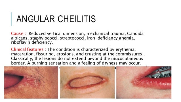 Mild Angular Cheilitis