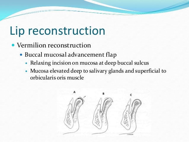 Tongue Reconstruction