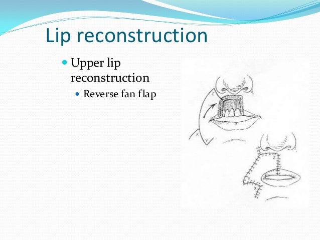 Lip n cheek recons