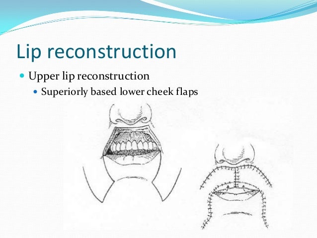 Lip n cheek recons