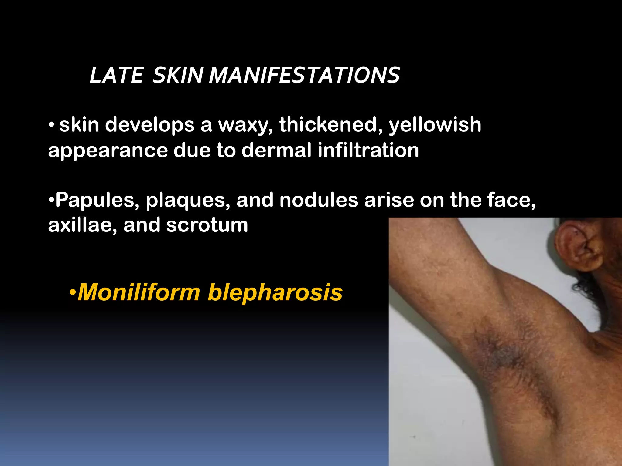 Lipoid proteinosis- Urbach wiethe disease - A rare case... dr.suresh ...