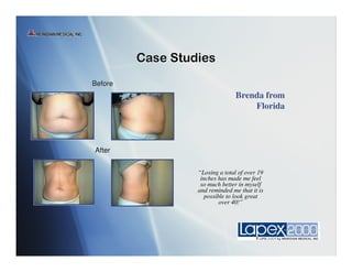 Lipo laser presentation | PPT