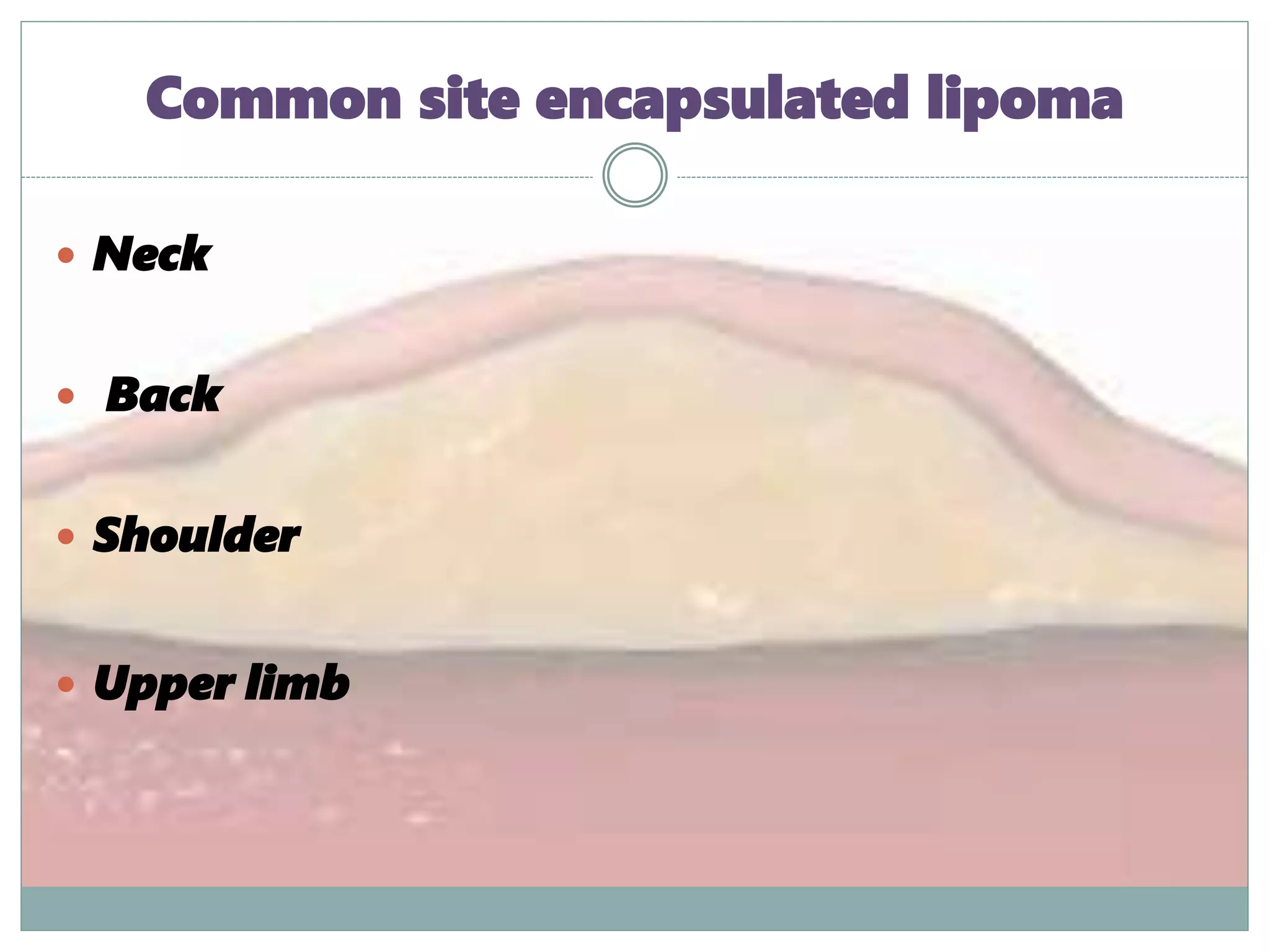 Lipoma | PPTX