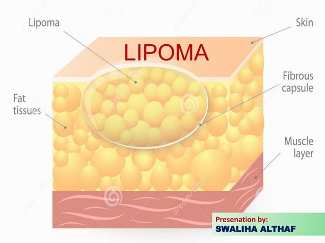Lipoma | PPTX | Cancer | Diseases and Conditions