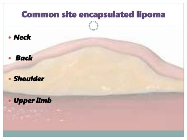 Lipoma | PPTX | Cancer | Diseases and Conditions