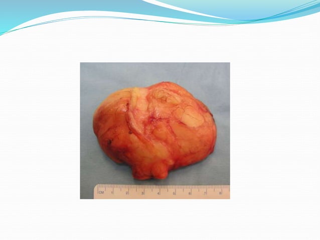 Lipomas | PPTX | Skin and Dermatology | Diseases and Conditions