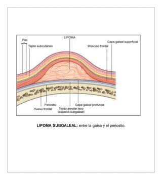 LIPOMA SUBGALEAL EN REGIÓN FRONTAL | DOCX
