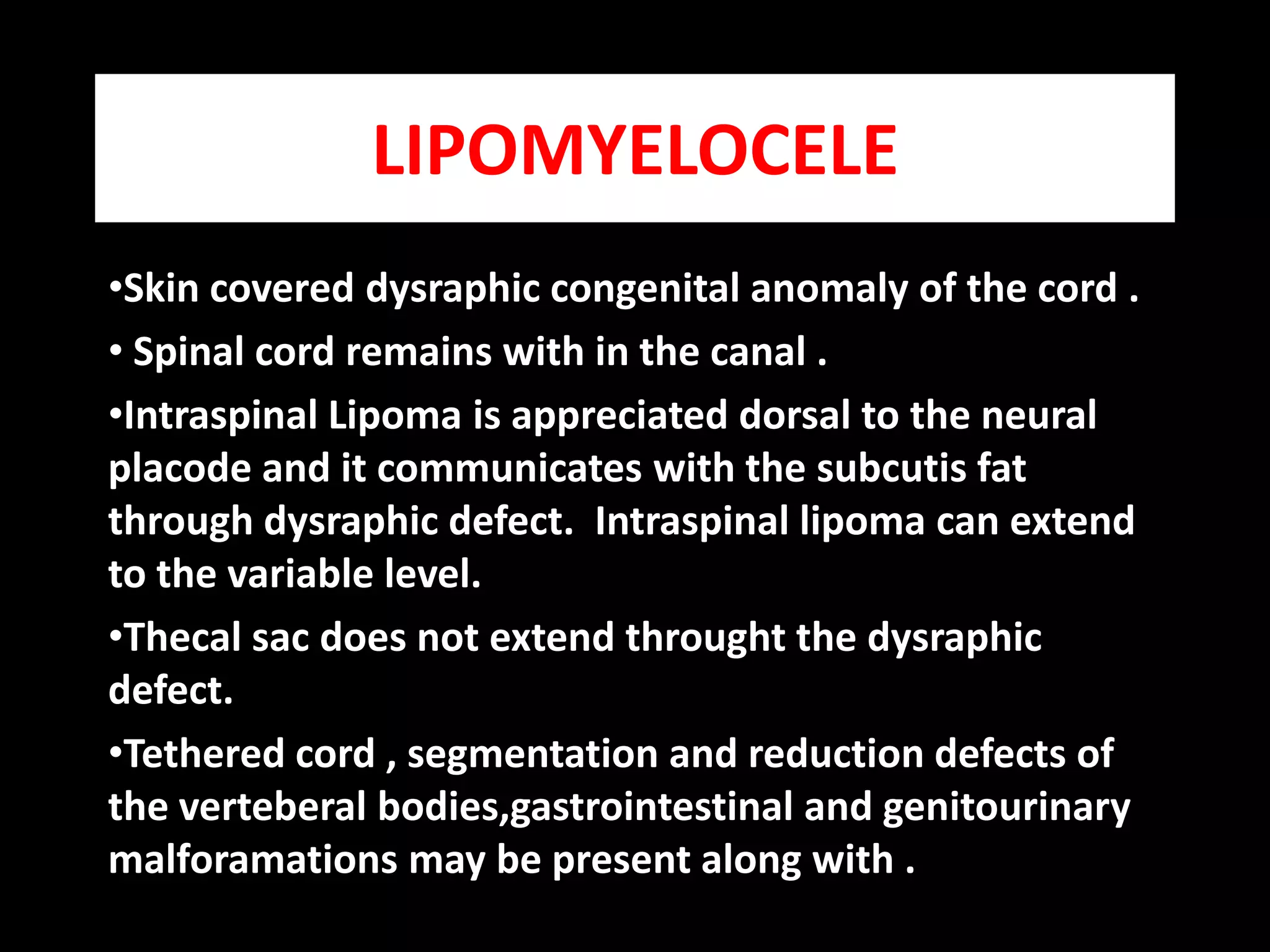 Lipomyelocele powerpoint presentation. | PPTX
