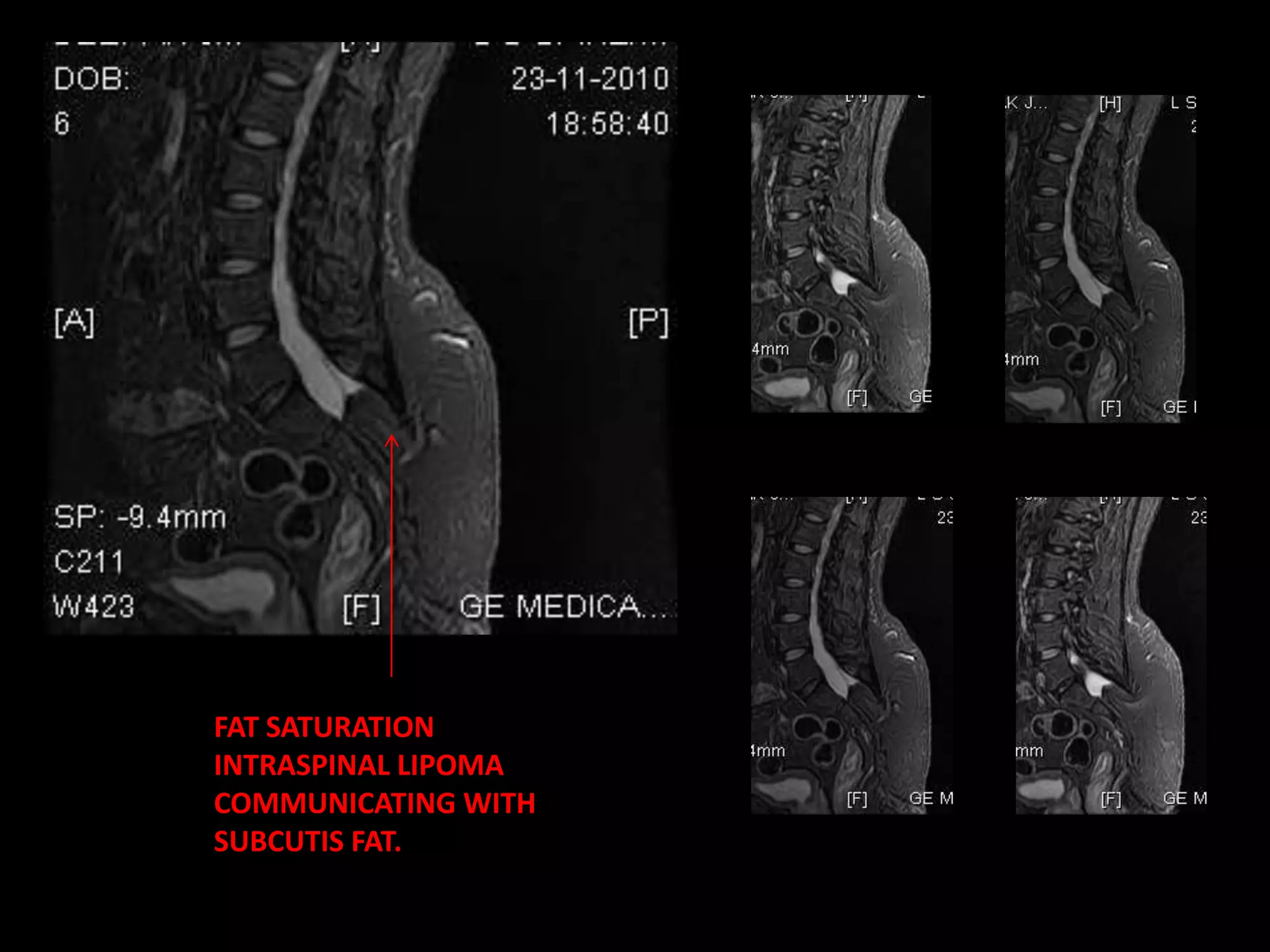 Lipomyelocele powerpoint presentation. | PPTX