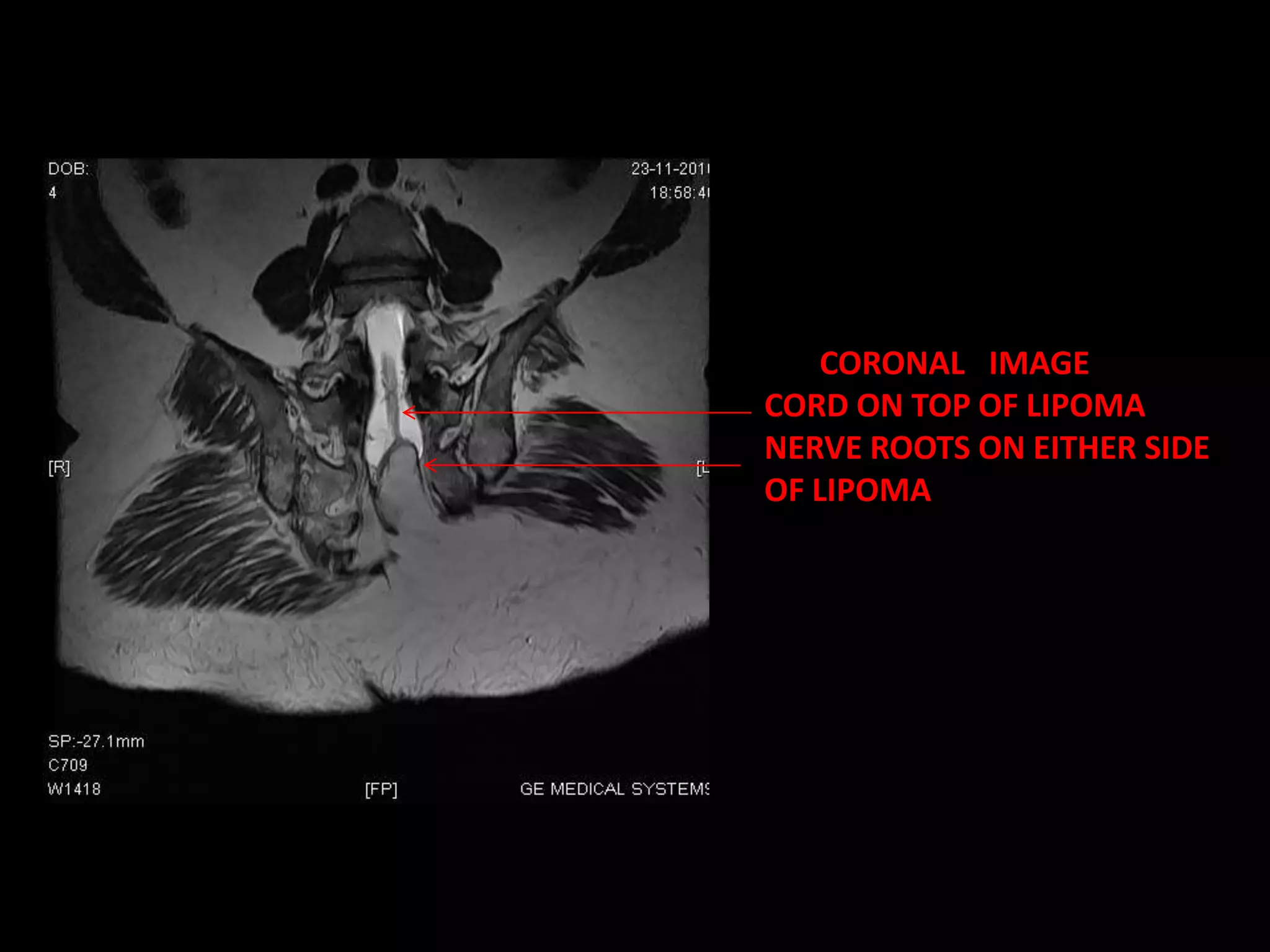 Lipomyelocele powerpoint presentation. | PPTX